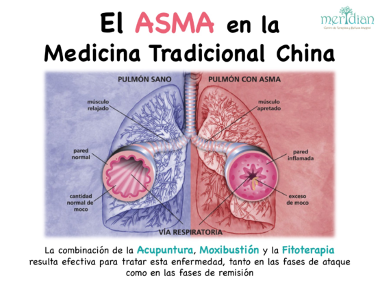 ASMA EN LA MEDICINA TRADICIONAL CHINA – MERIDIAN